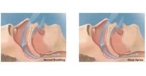 Snoring and Obstructive Sleep Apnea - New