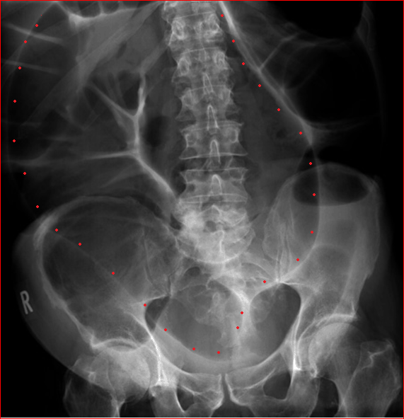 Sigmoid Volvulus - New