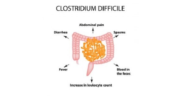 Clostridium difficile - New