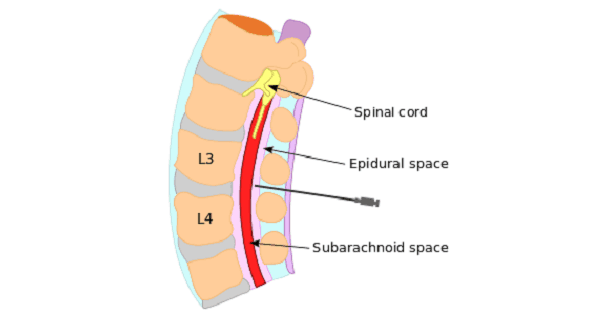 Epidural anaesthesia - New