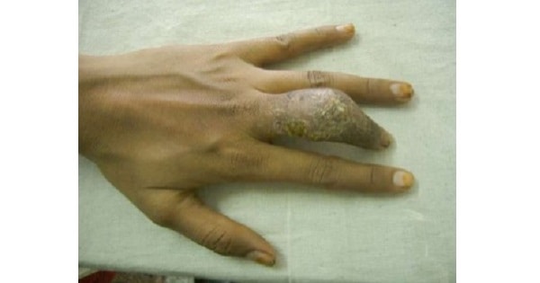 Skeletal Tuberculosis - New