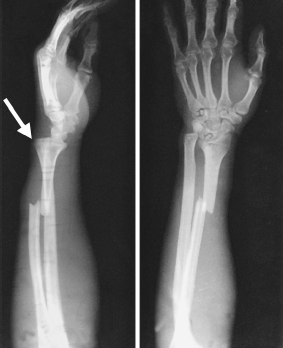 Galeazzi fracture - New