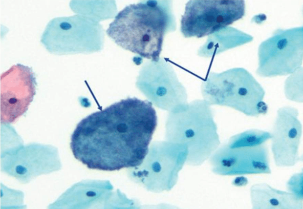 Bacterial Vaginosis Cytology