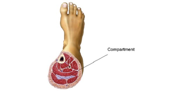 Compartment Syndrome - New