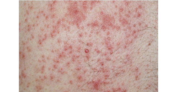 Dermatitis - www.medicoapps.org