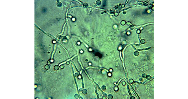 Candida: Diagnosis and Treatment - New