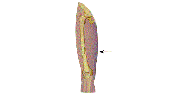 Green stick fracture - New