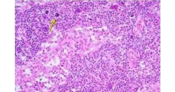 Measles - www.medicoapps.org