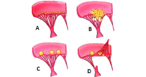 Infective Endocarditis - www.medicoapps.org