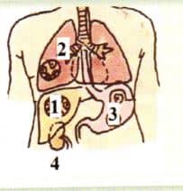 HYDATID CYST - www.medicoapps.org