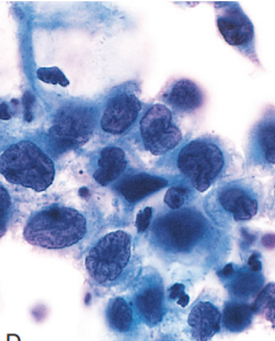 Cervical intraepithelial neoplasia (CIN) - New