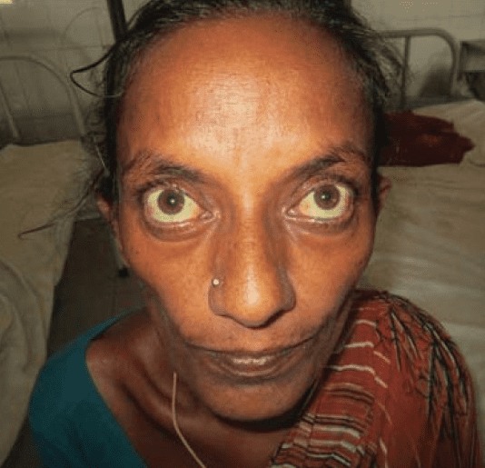 Thyrotoxicosis - New