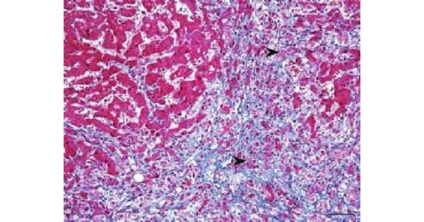 Aflatoxicosis - www.medicoapps.org