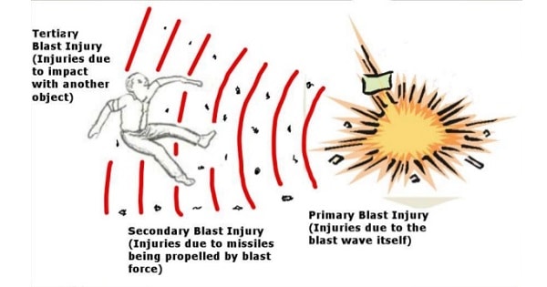 Explosion injury - New