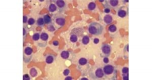 Plasma Cell Disorder - New