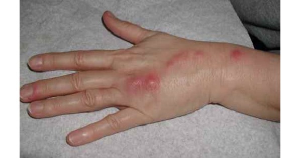 Sporothrix schenckii - New