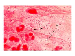 Haemophilus influenzae Archives - www.medicoapps.org