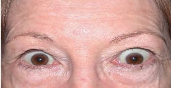 THYROID OPTHALMOPATHY - New