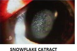 Snowflake Cataract