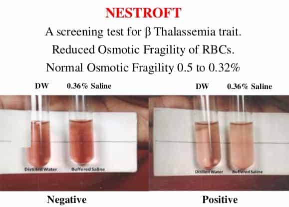 THALASSEMIA - www.medicoapps.org