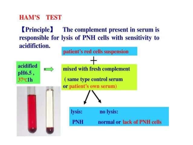 PAROXYSMAL NOCTURNAL HEMOGLOBINURIA (PNH) - New