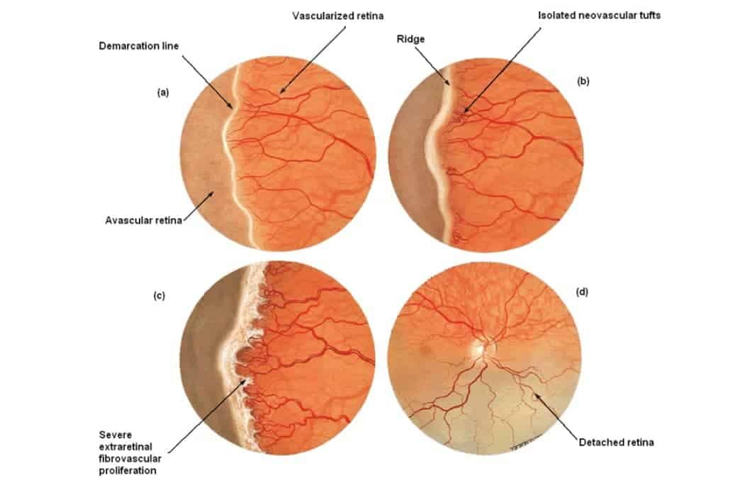 Retinopathy Of Prematurity - www.medicoapps.org