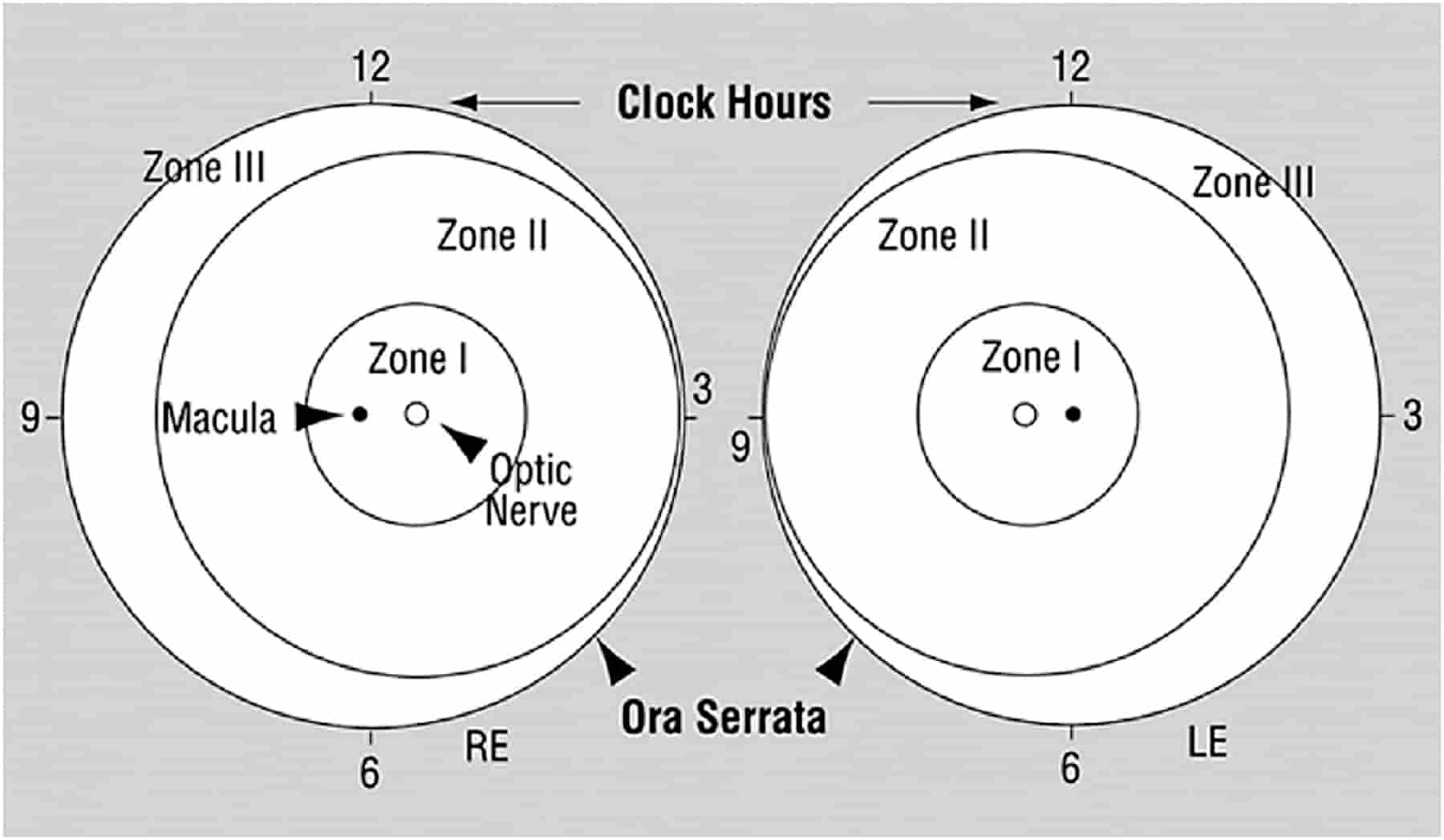 RETINOPATHY OF PREMATURITY - New