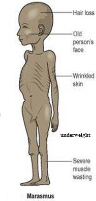 Marasmus - www.medicoapps.org