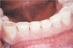 Age Determination- Teeth - New