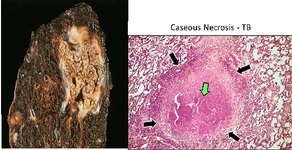 Caseous TB - New