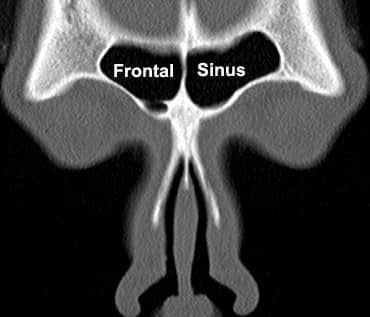 Frontal Sinus - New