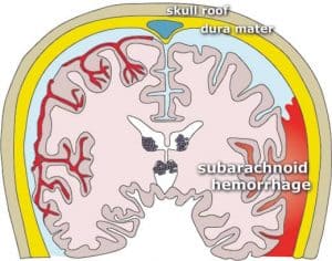 English Class Ct Brain Hemorrhage Fig13 Subarachnoid Hemorrhage