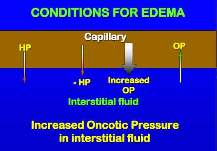 Edema- basics - www.medicoapps.org