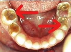 Bulimia Nervosa - New