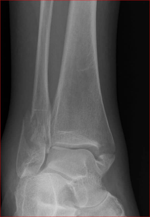 INJURIES AROUND THE ANKLE (Pott’s Fracture) - www.medicoapps.org