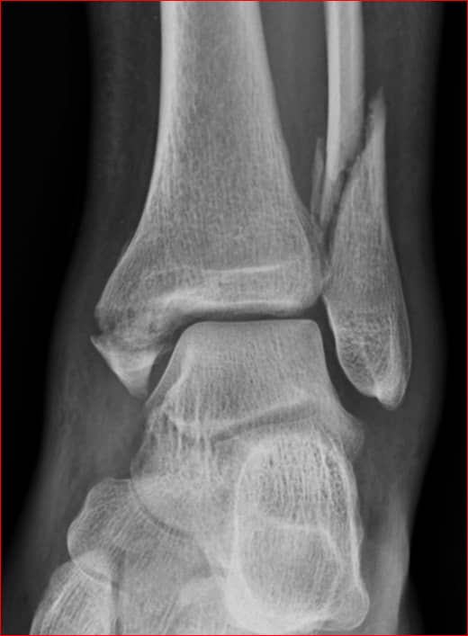 INJURIES AROUND THE ANKLE (Pott’s Fracture) - www.medicoapps.org