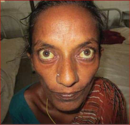 Thyrotoxicosis - New