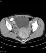 MULLERIAN DUCT ANOMALIES - New