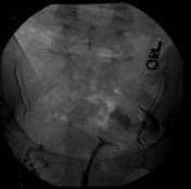 MULLERIAN DUCT ANOMALIES - New