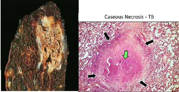 Necrosis - www.medicoapps.org