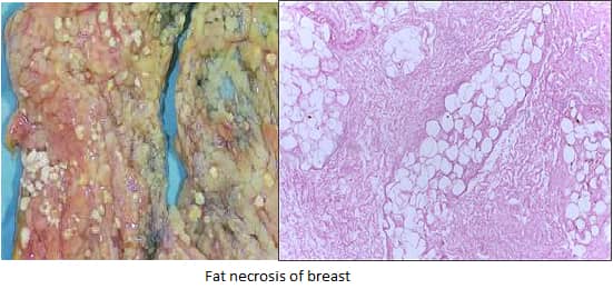 Fat Necrosis Pancreas