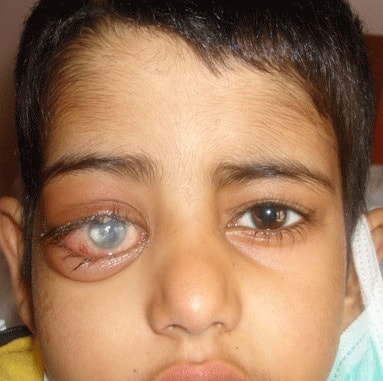 Chloroma - www.medicoapps.org