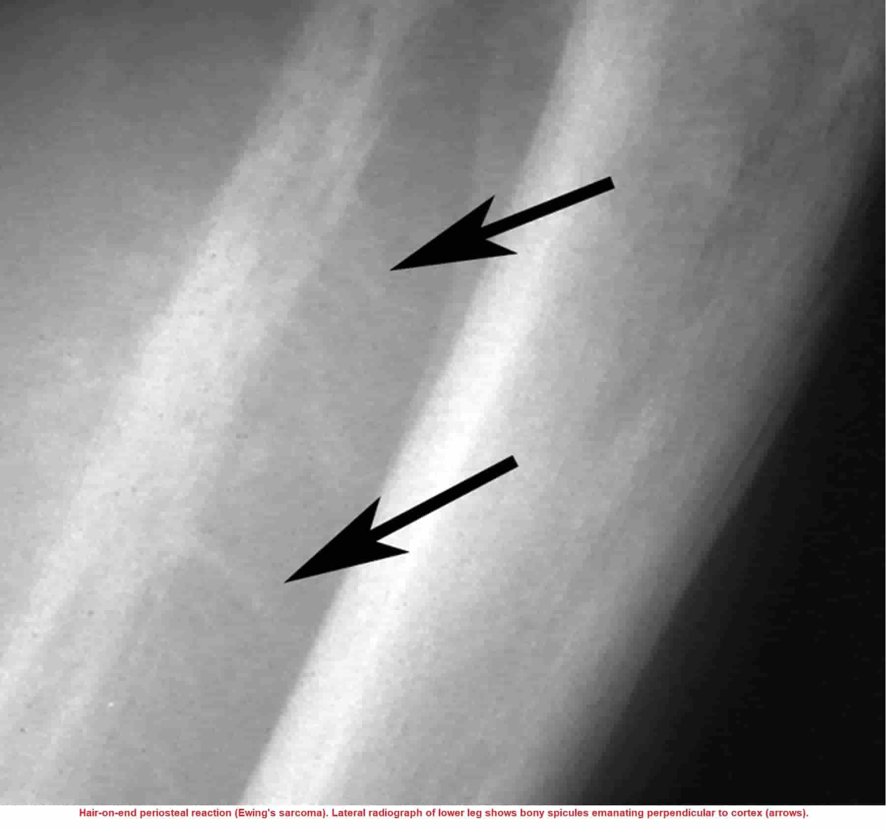 PERIOSTEAL REACTION - New