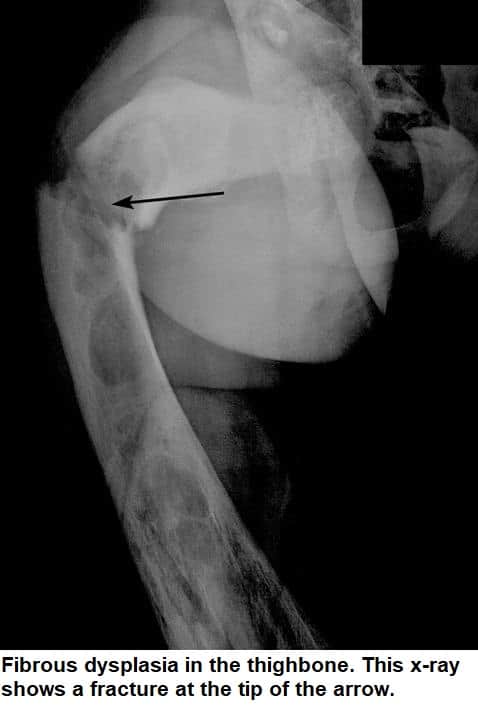 Fibrous Dysplasia - New