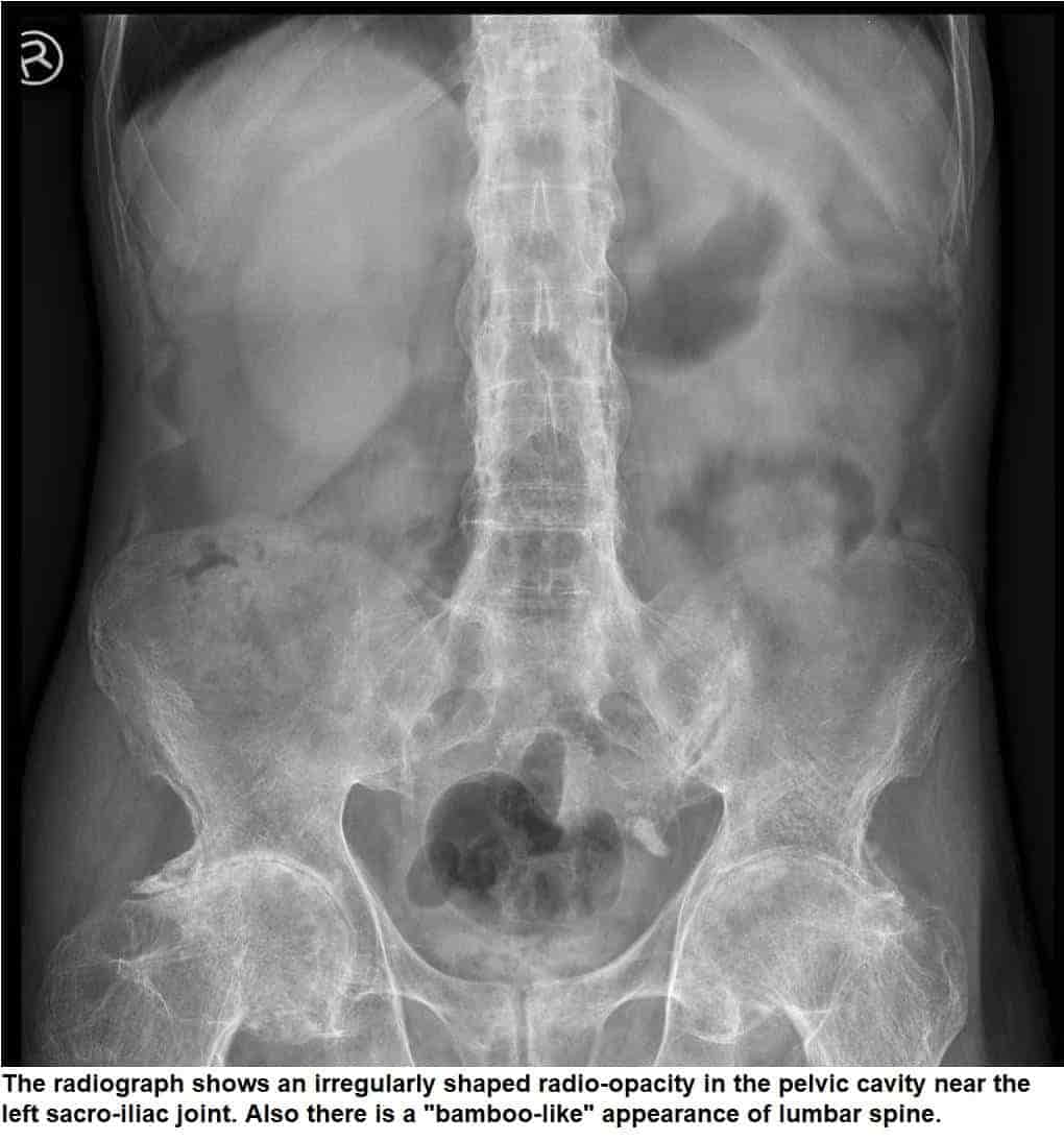 Ankylosing Spondylitis - www.medicoapps.org