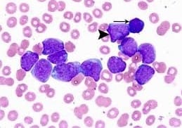 Acute myeloid leukemia (AML) - New