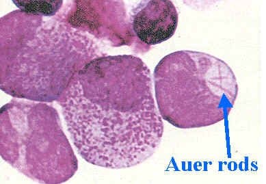 Acute myeloid leukemia (AML) - New