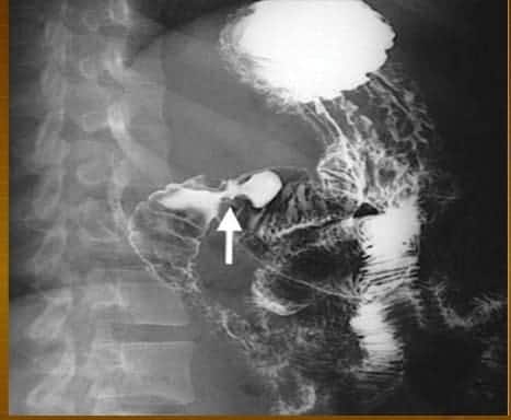 Chronic Duodenal Ulcer - www.medicoapps.org