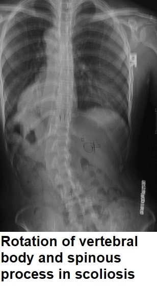 SCOLIOSIS - New