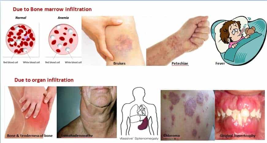 Acute myeloid leukemia (AML) - New